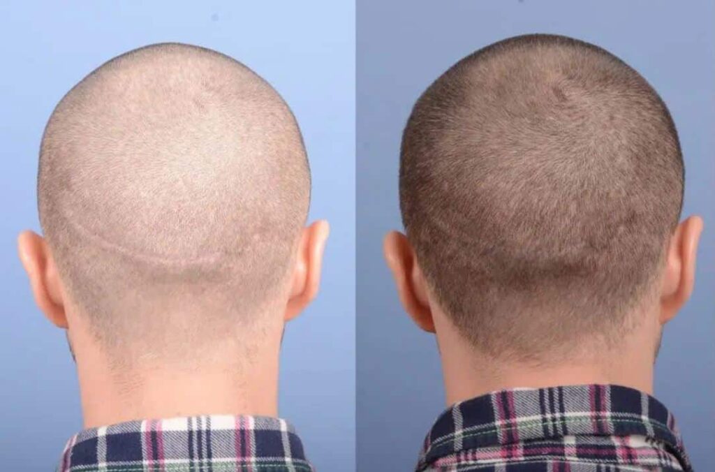 Top Scalp Micropigmentation Minneapolis, MN | Shapiro Medical